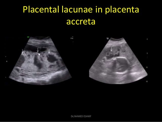 12-placenta imaging Dr Ahmed Esawy