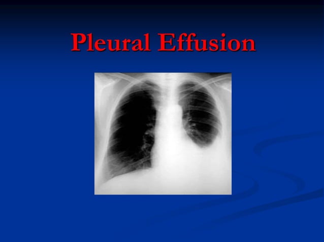 12-PLEURAL EFFUSION.ppt