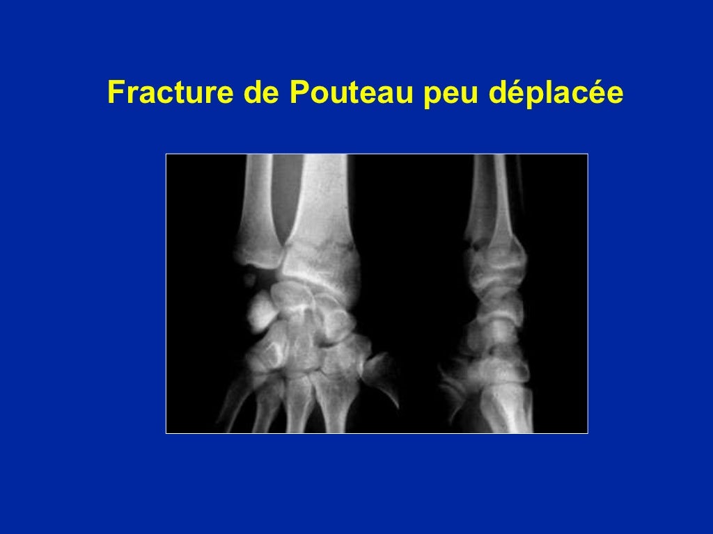 12 Poignet Fractures