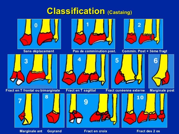 12 poignet - fractures