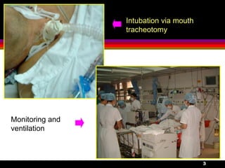 12.Respiratory Failure | PPT