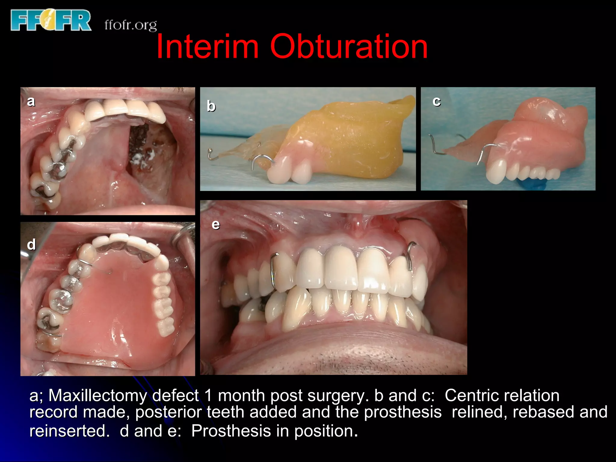 Surgical and Interim Obturation | PPT