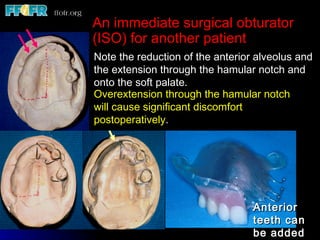 Surgical and Interim Obturation | PPT