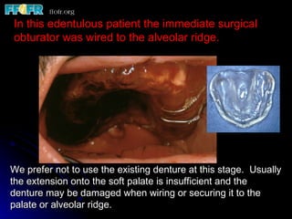 Surgical and Interim Obturation | PPT