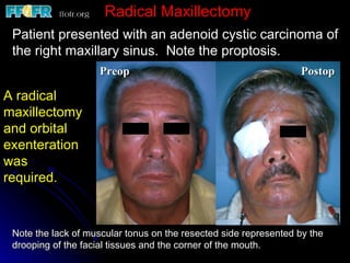 Surgical and Interim Obturation | PPT