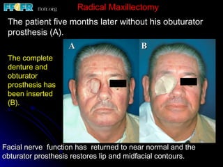 Surgical and Interim Obturation | PPT