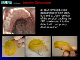 Surgical and Interim Obturation | PPT