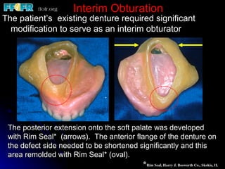 Surgical and Interim Obturation | PPT