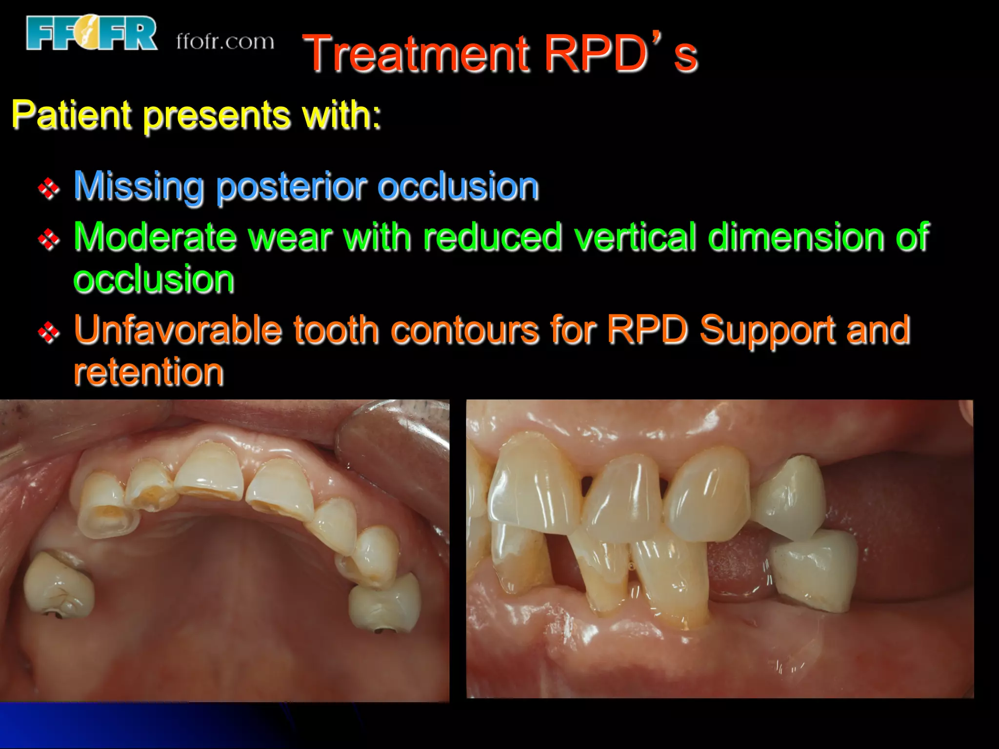 12.surveyed crowns and combined fixed rpd cases | PDF