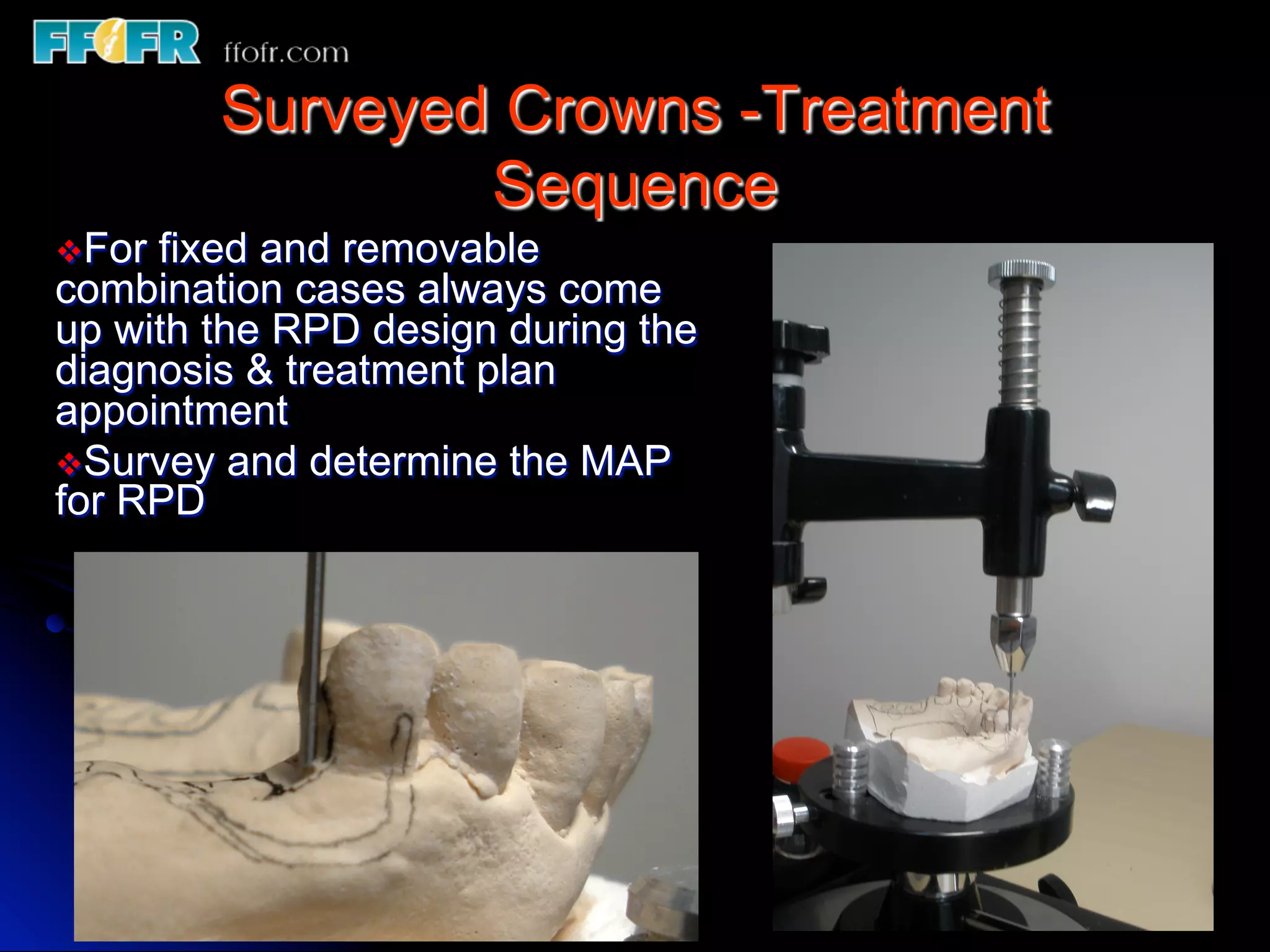 12.surveyed crowns and combined fixed rpd cases | PDF