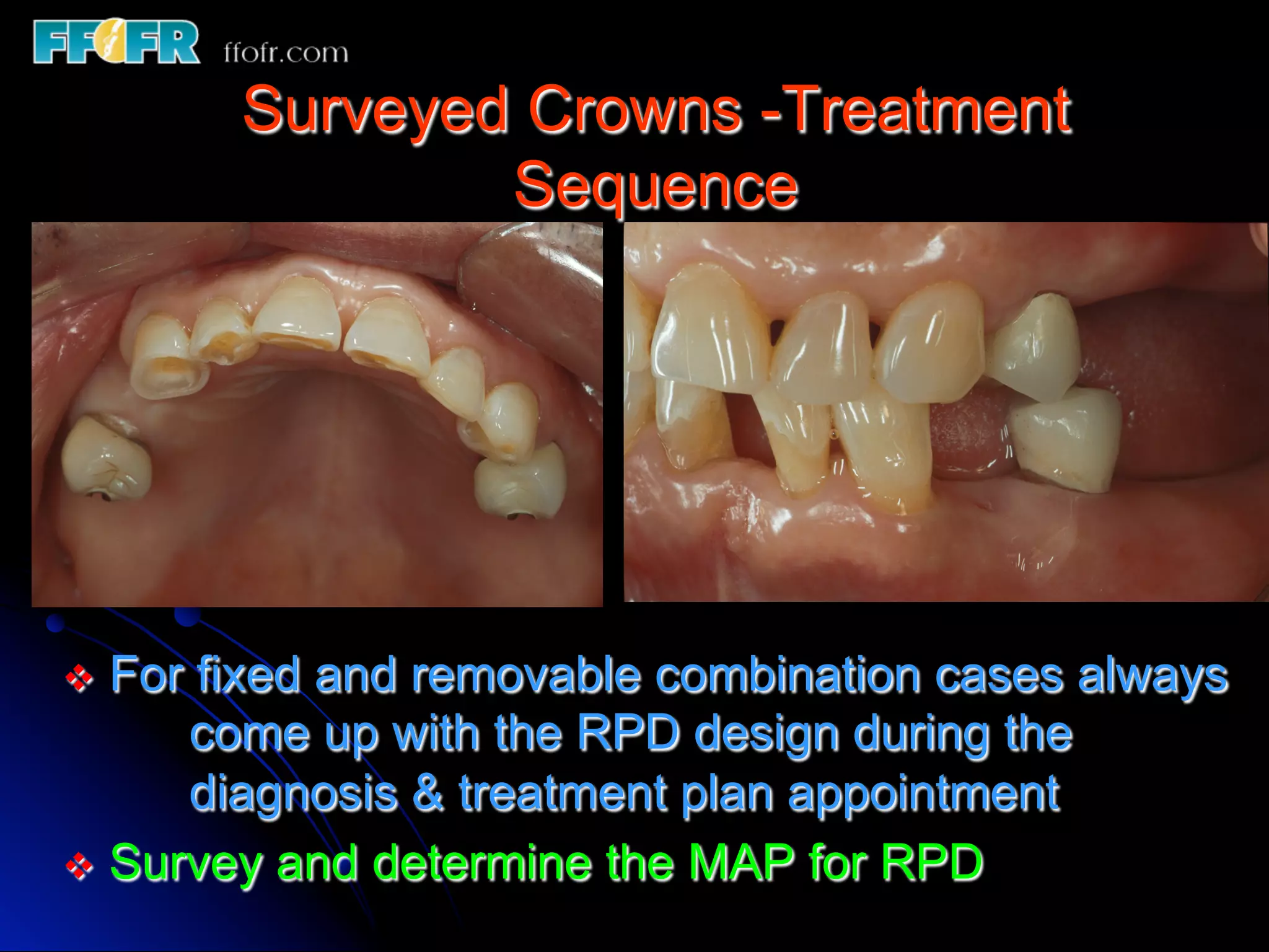 12.surveyed crowns and combined fixed rpd cases | PDF