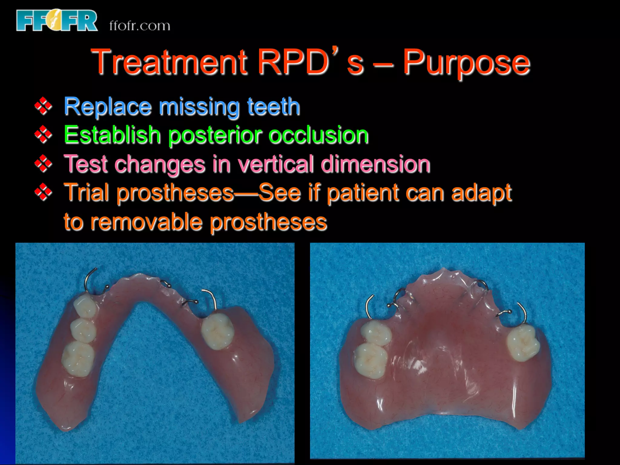 12.surveyed crowns and combined fixed rpd cases | PDF