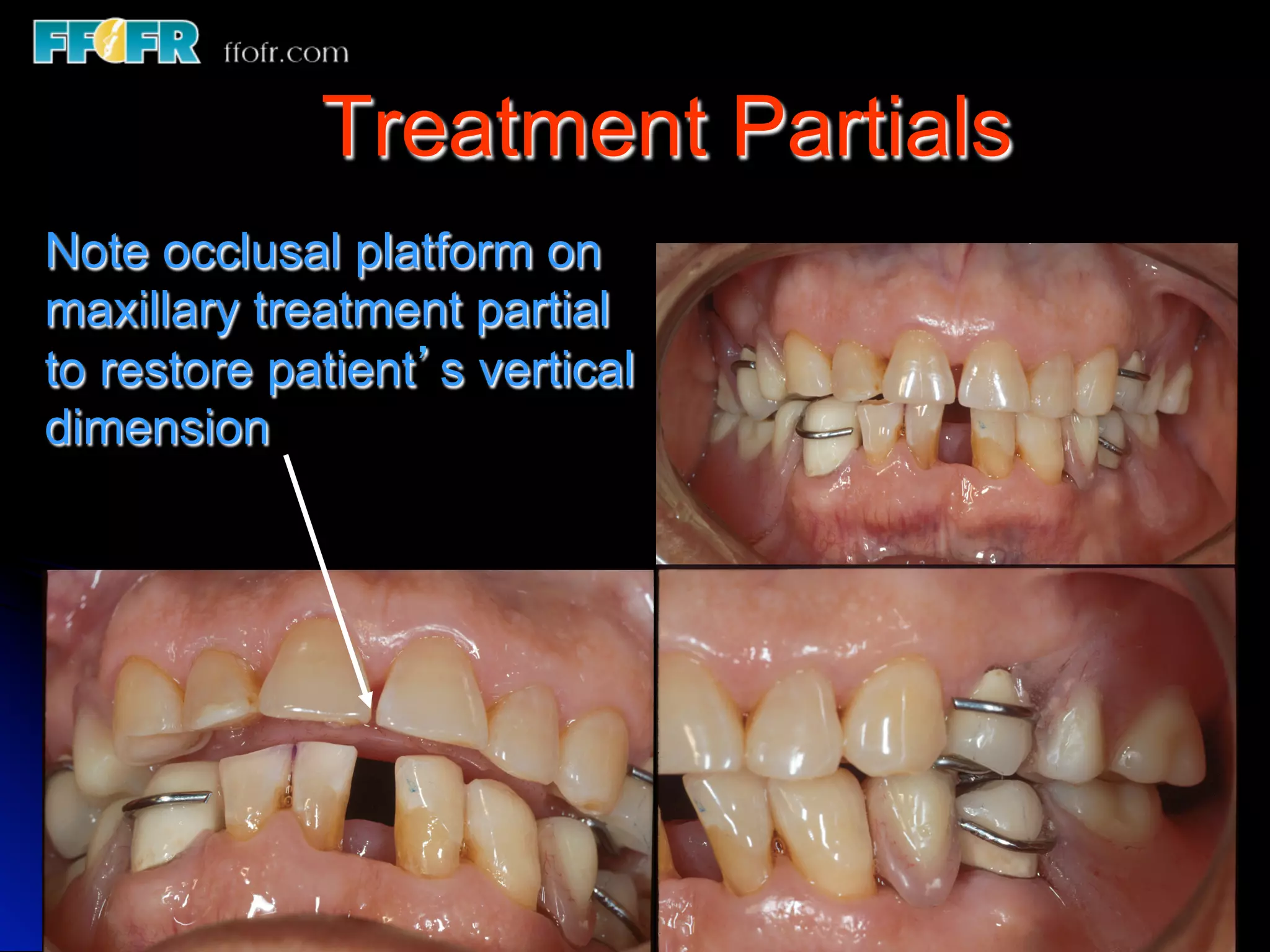 12.surveyed crowns and combined fixed rpd cases | PDF