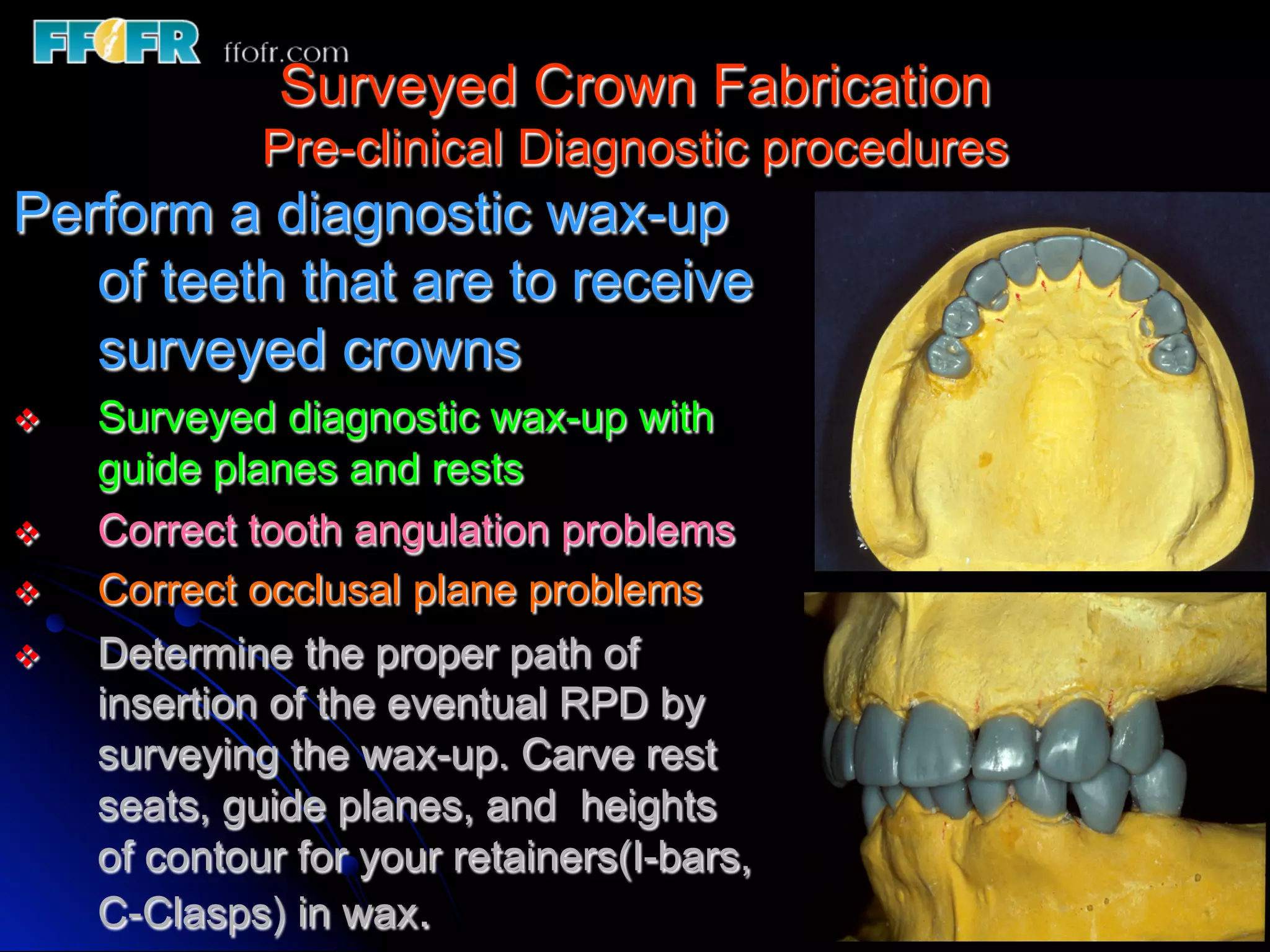 12.surveyed crowns and combined fixed rpd cases | PDF