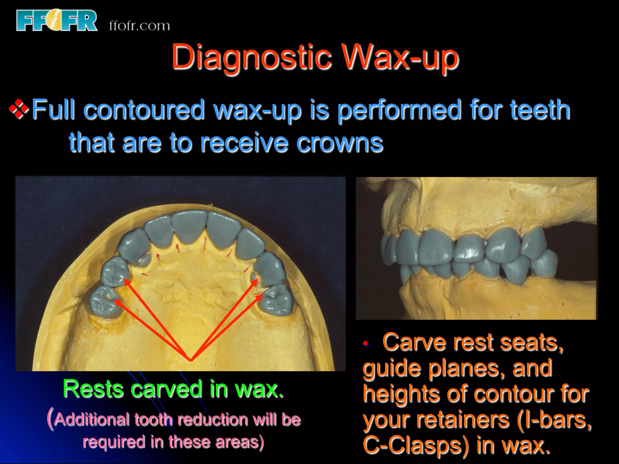 12.surveyed crowns and combined fixed rpd cases | PDF