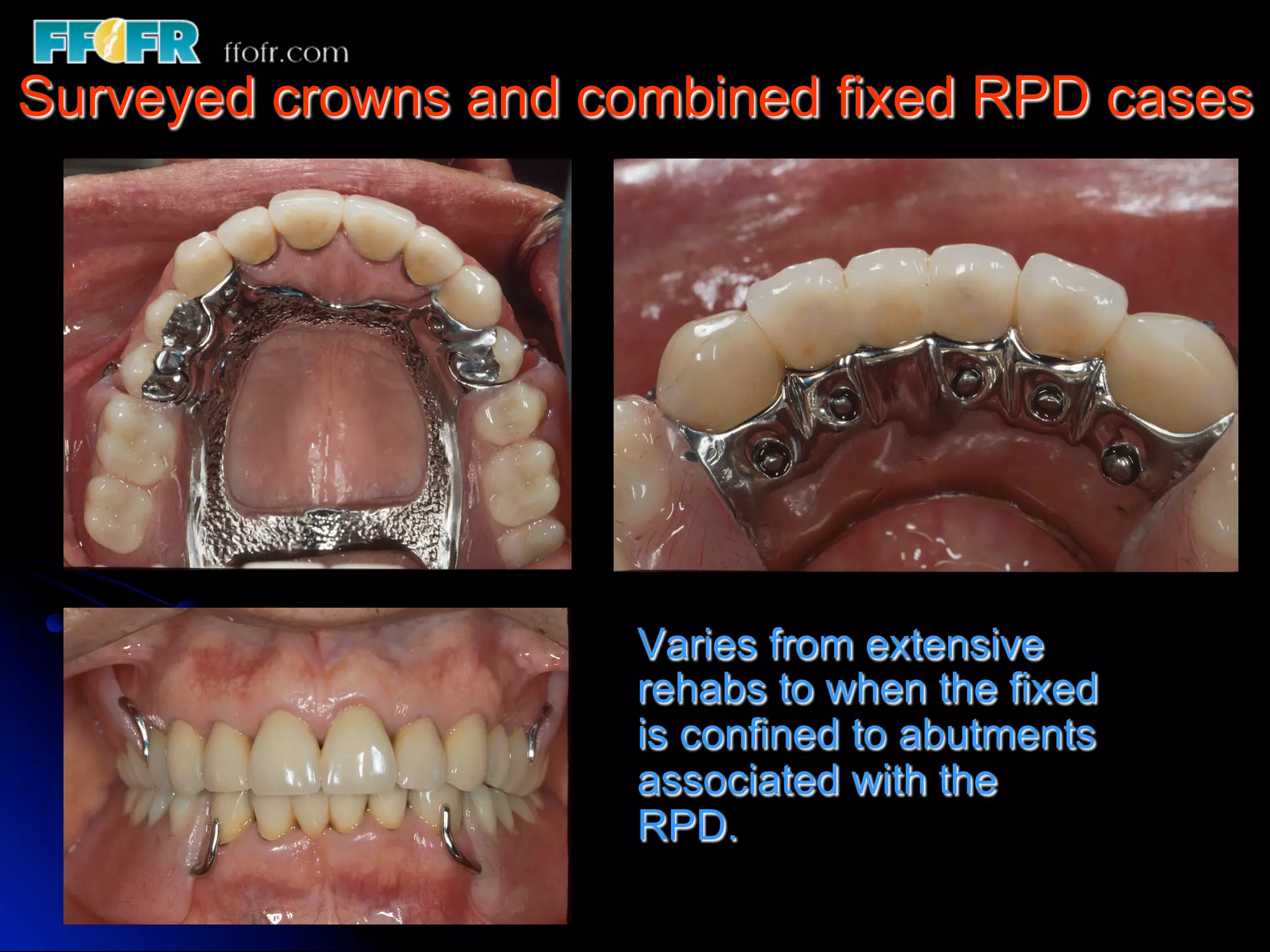 12.surveyed crowns and combined fixed rpd cases | PDF
