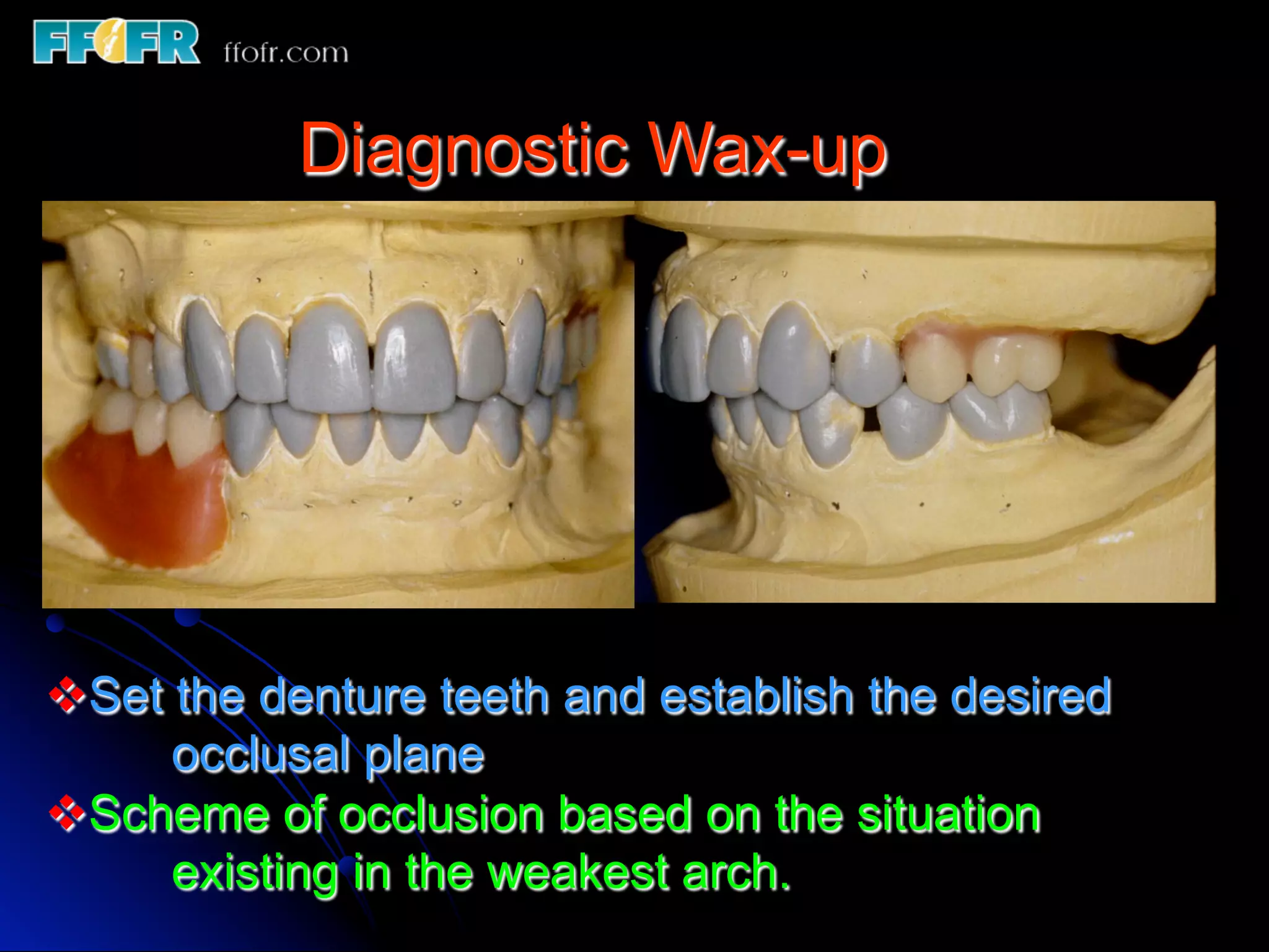 12.surveyed crowns and combined fixed rpd cases | PDF