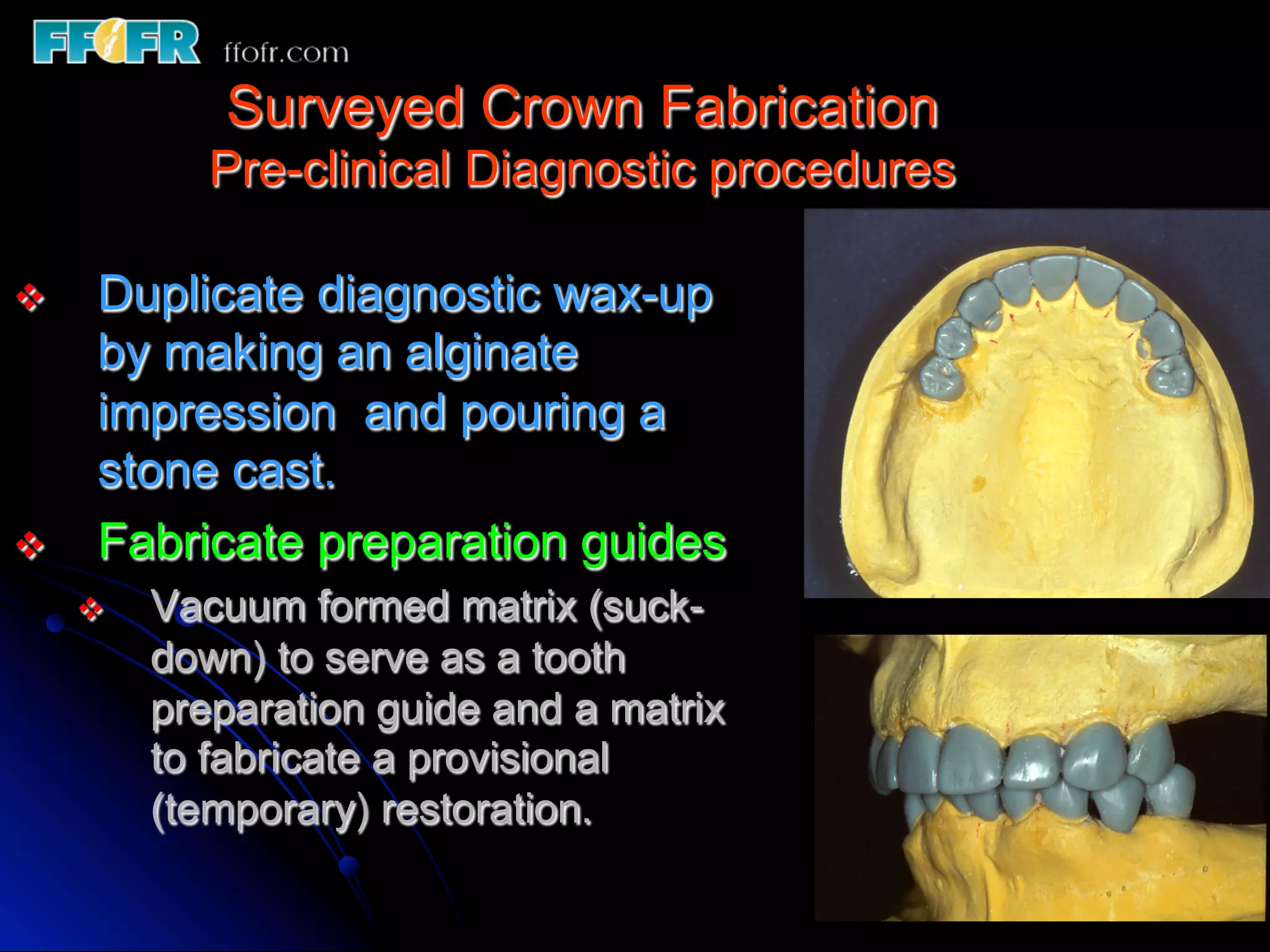 12.surveyed crowns and combined fixed rpd cases | PDF