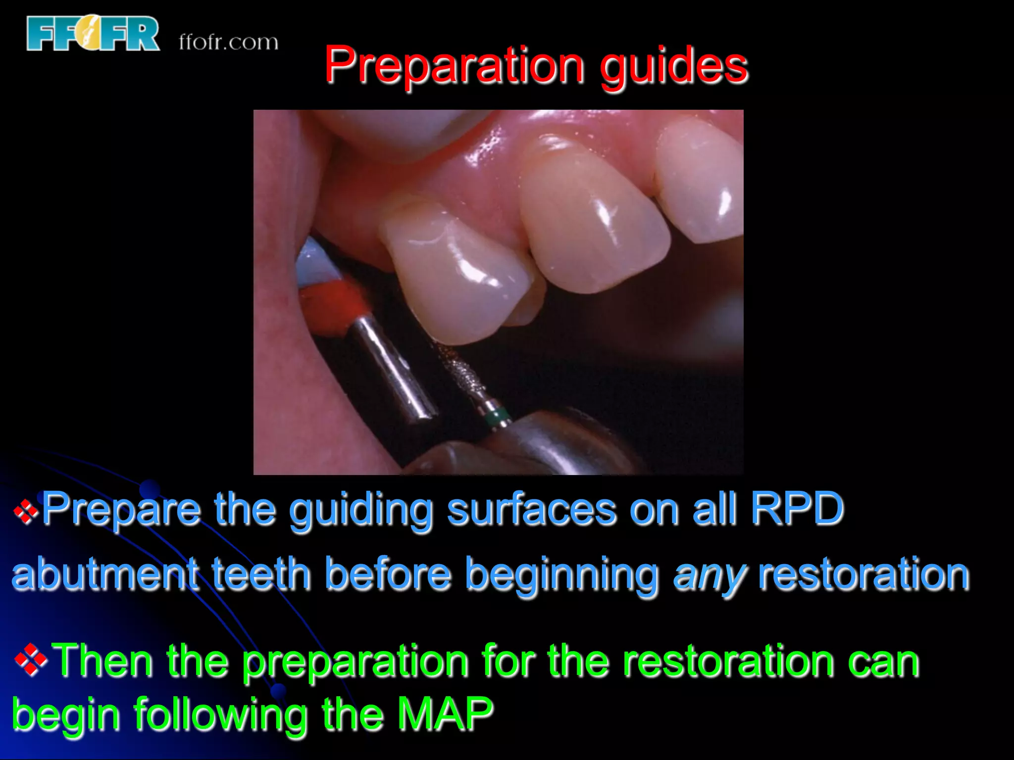 12.surveyed crowns and combined fixed rpd cases | PDF