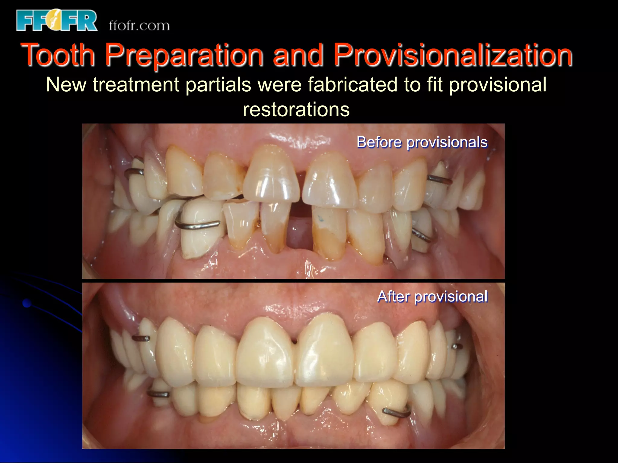 12.surveyed crowns and combined fixed rpd cases | PDF