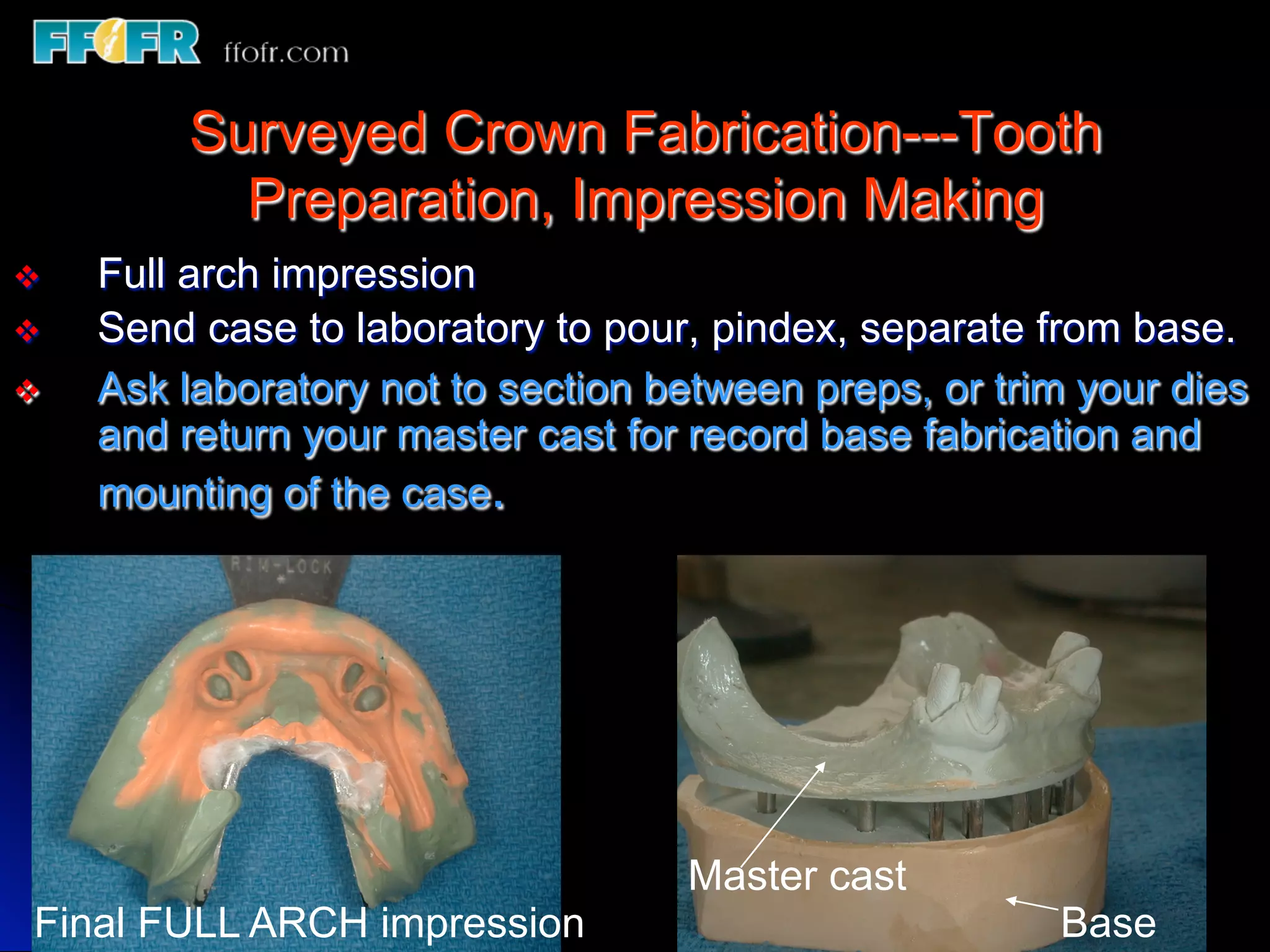 12.surveyed crowns and combined fixed rpd cases | PDF
