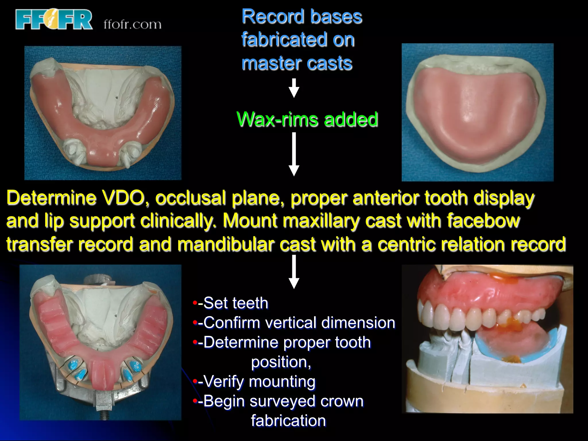 12.surveyed crowns and combined fixed rpd cases | PDF
