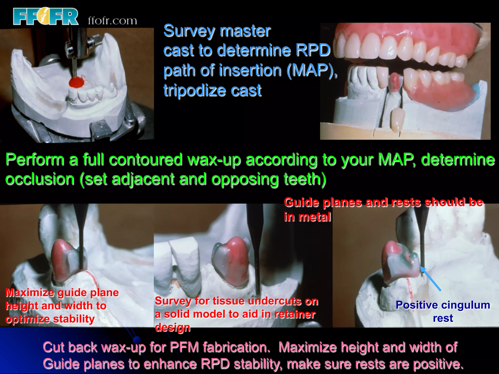 12.surveyed crowns and combined fixed rpd cases | PDF