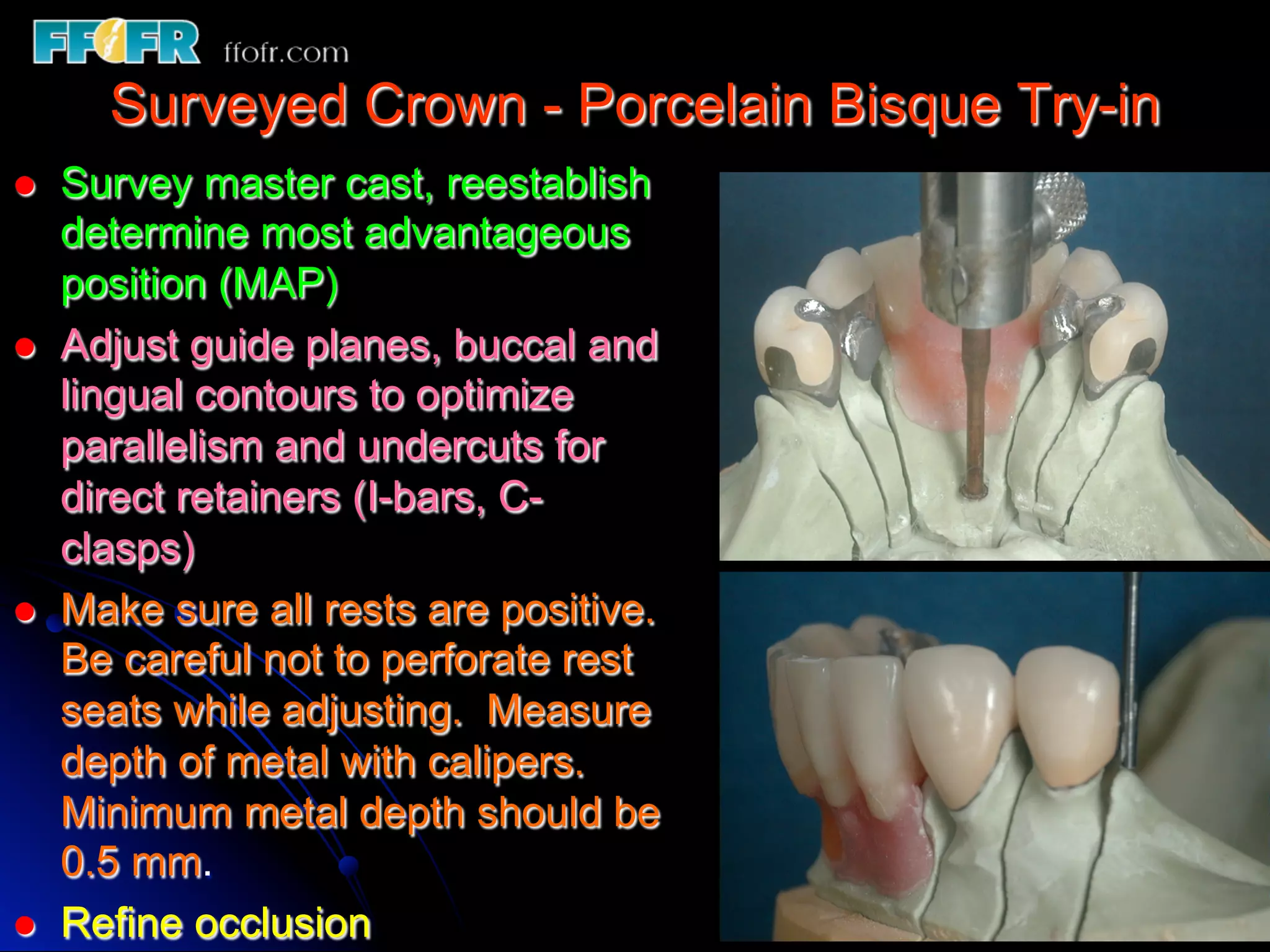 12.surveyed crowns and combined fixed rpd cases | PDF