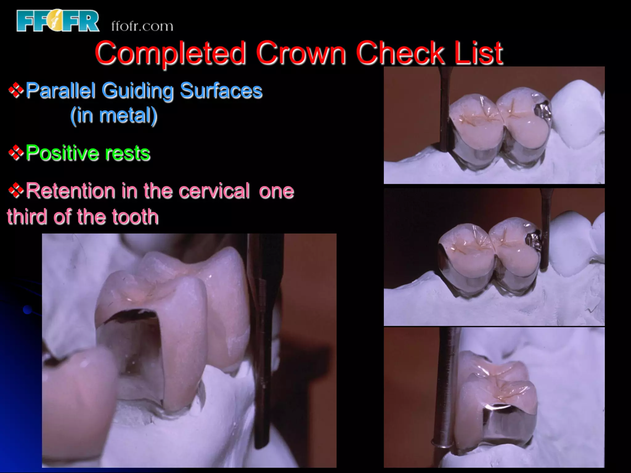 12.surveyed crowns and combined fixed rpd cases | PDF