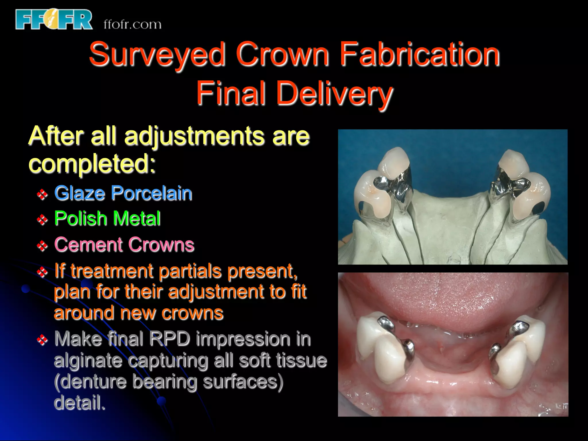 12.surveyed crowns and combined fixed rpd cases | PDF