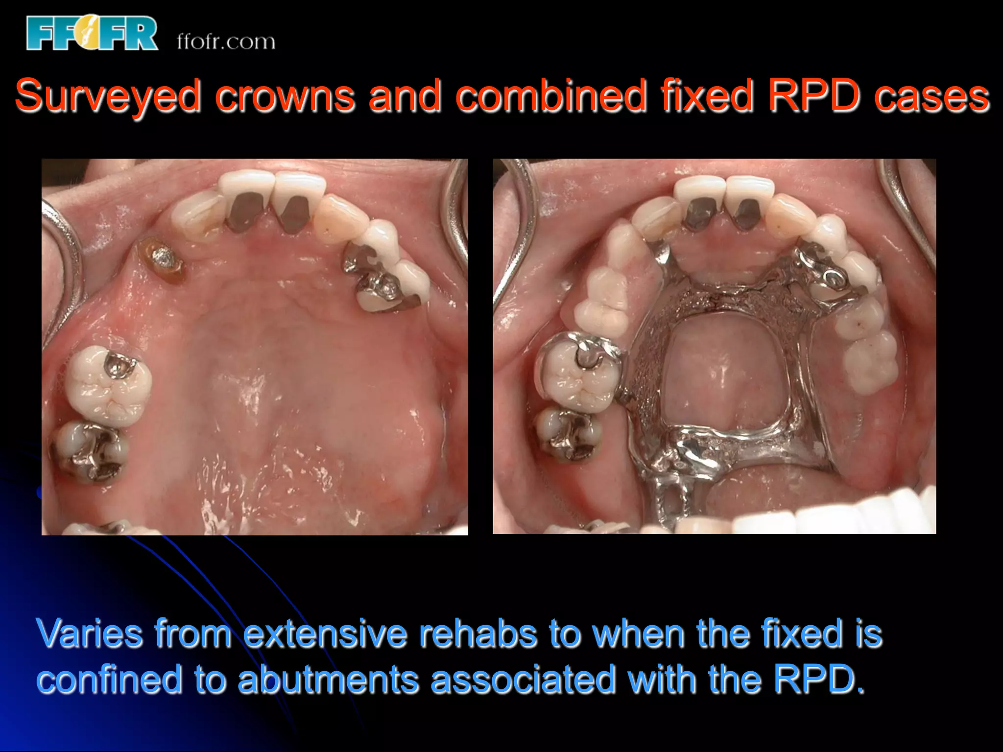 12.surveyed crowns and combined fixed rpd cases | PDF