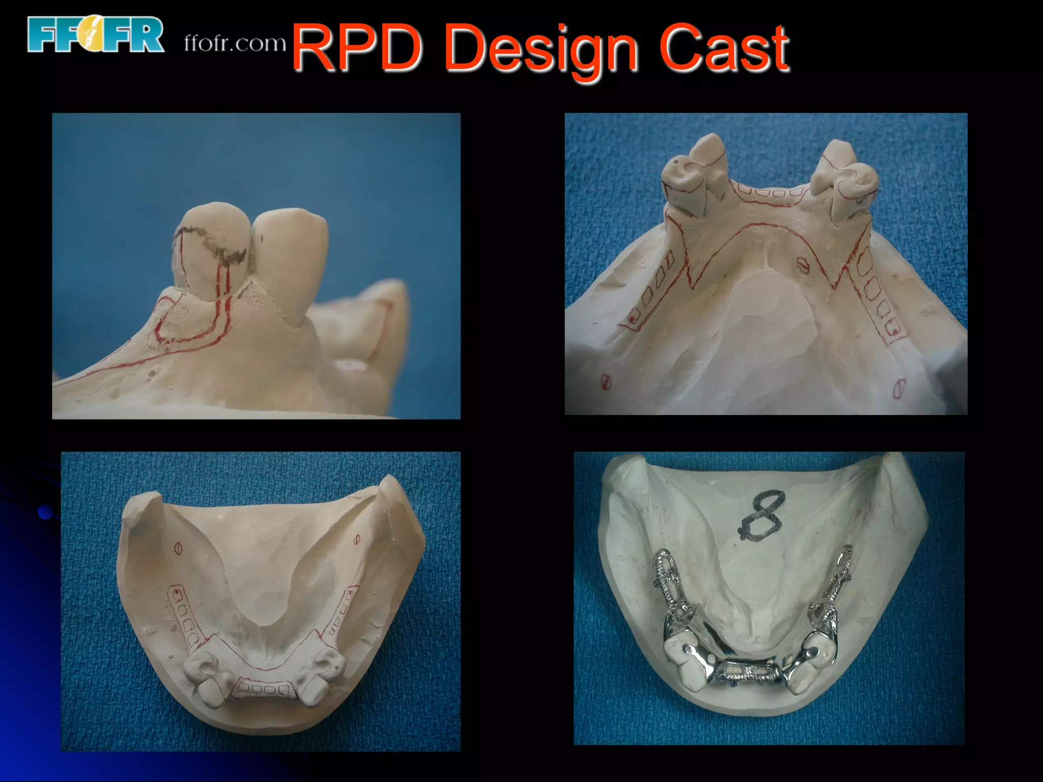 12.surveyed crowns and combined fixed rpd cases | PDF