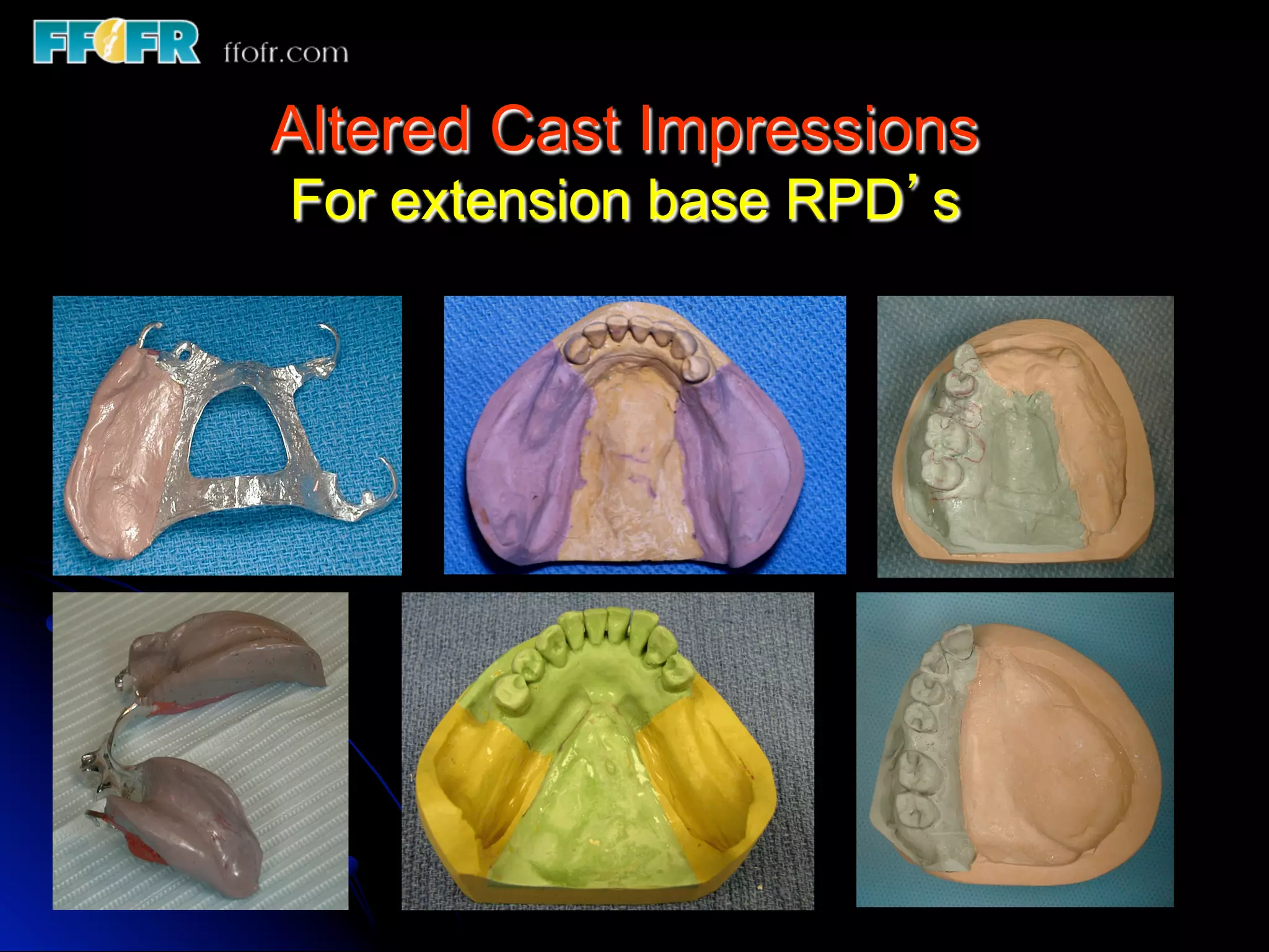 12.surveyed crowns and combined fixed rpd cases | PDF
