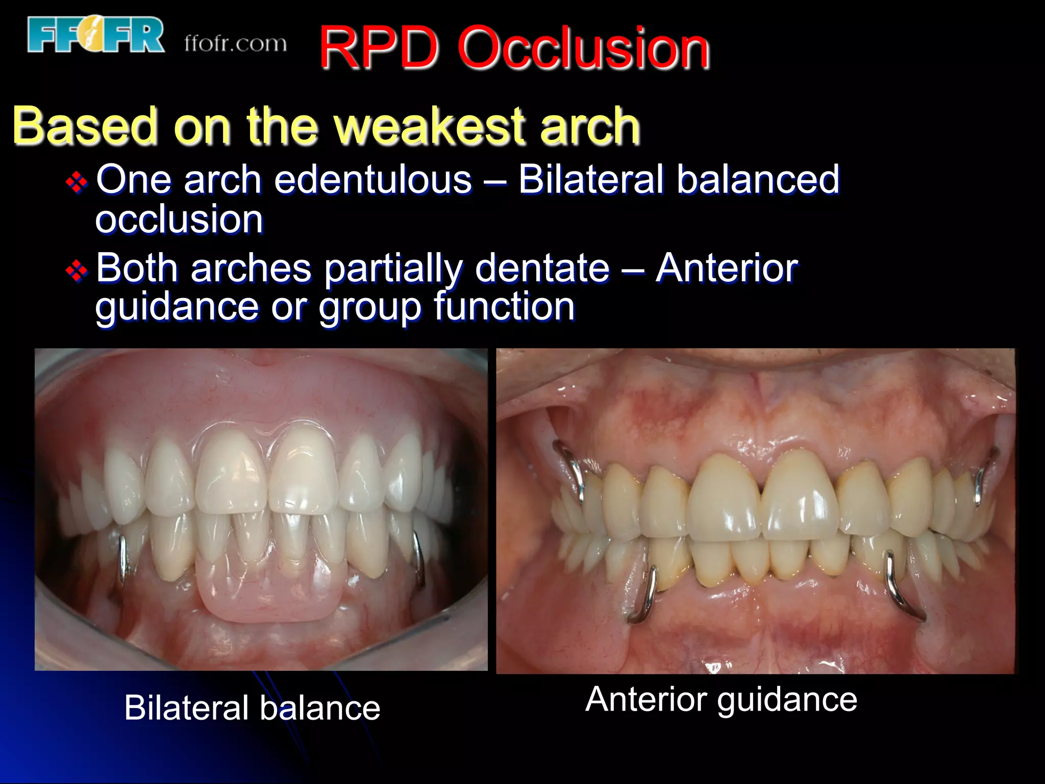 12.surveyed crowns and combined fixed rpd cases | PDF