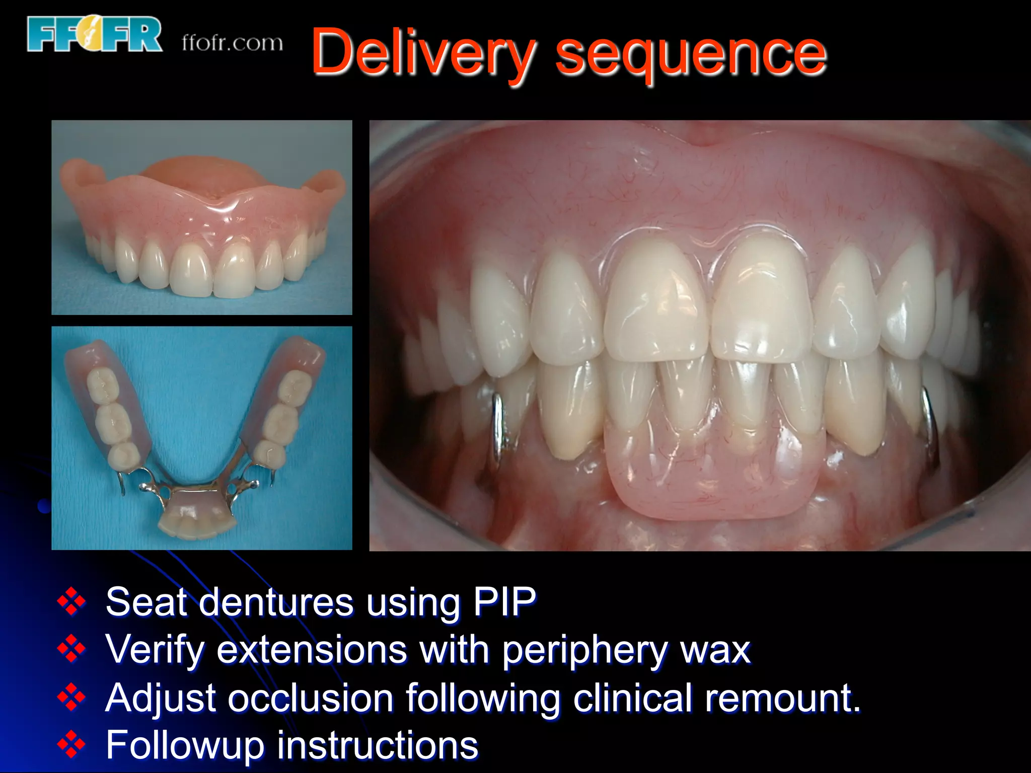 12.surveyed crowns and combined fixed rpd cases | PDF