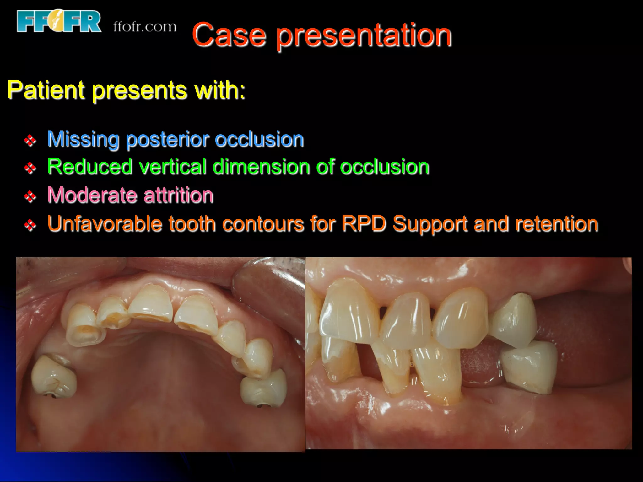 12.surveyed crowns and combined fixed rpd cases | PDF