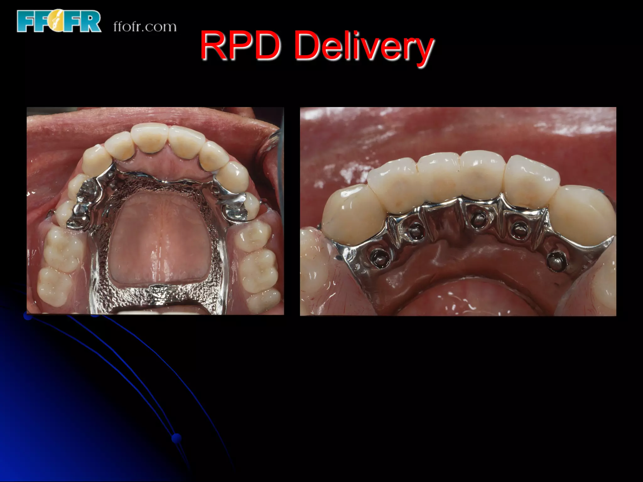 12.surveyed crowns and combined fixed rpd cases | PDF