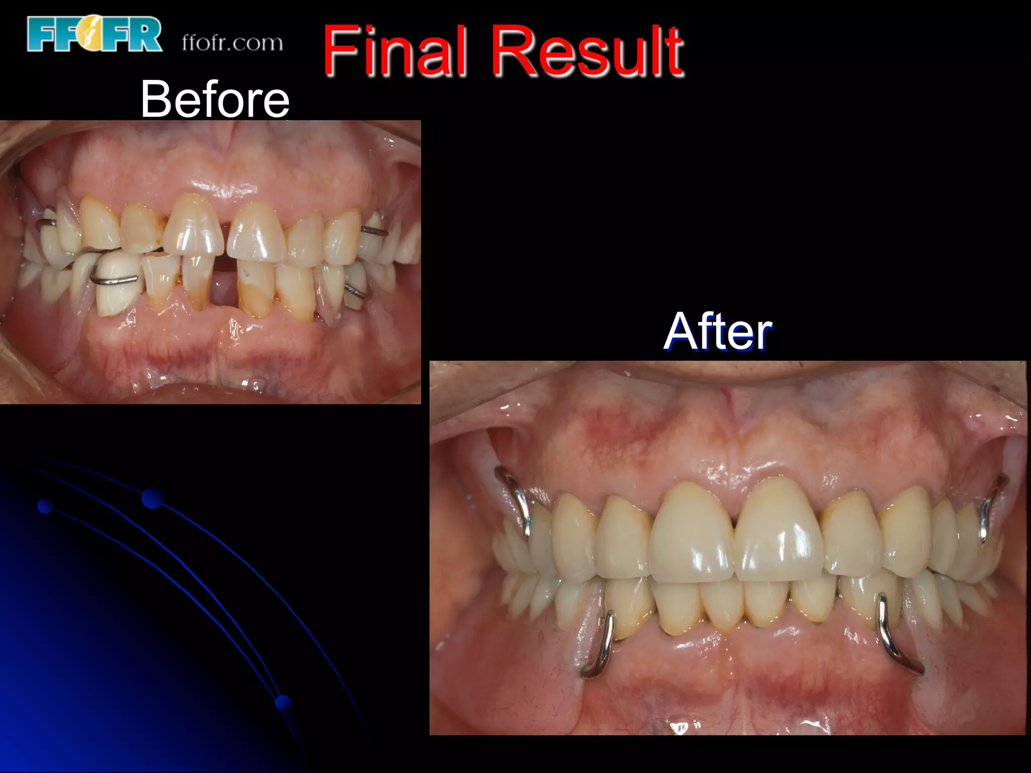 12.surveyed crowns and combined fixed rpd cases | PDF