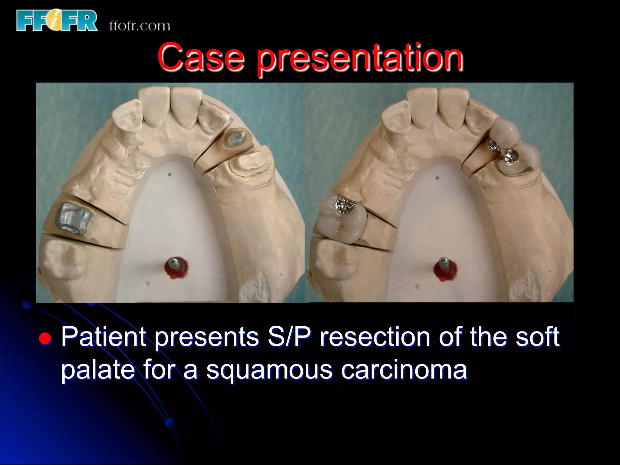 12.surveyed crowns and combined fixed rpd cases | PDF