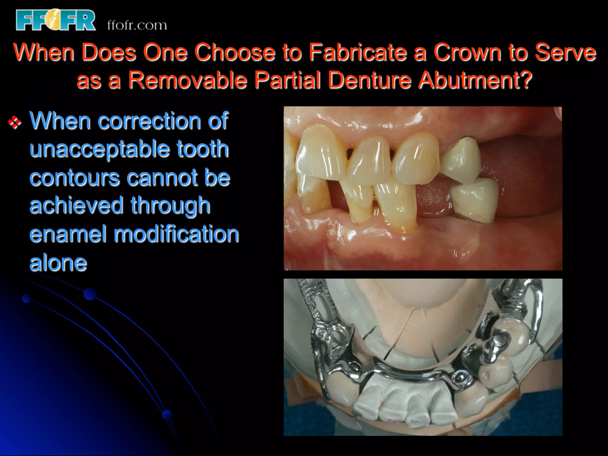 12.surveyed crowns and combined fixed rpd cases | PDF