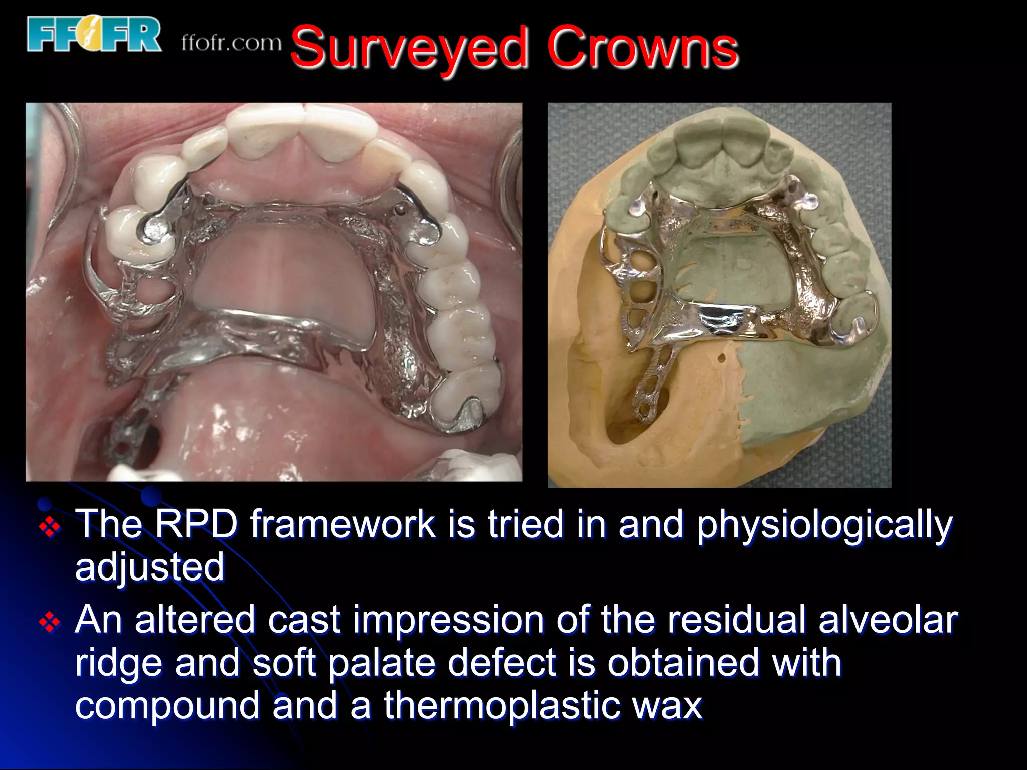 12.surveyed crowns and combined fixed rpd cases | PDF