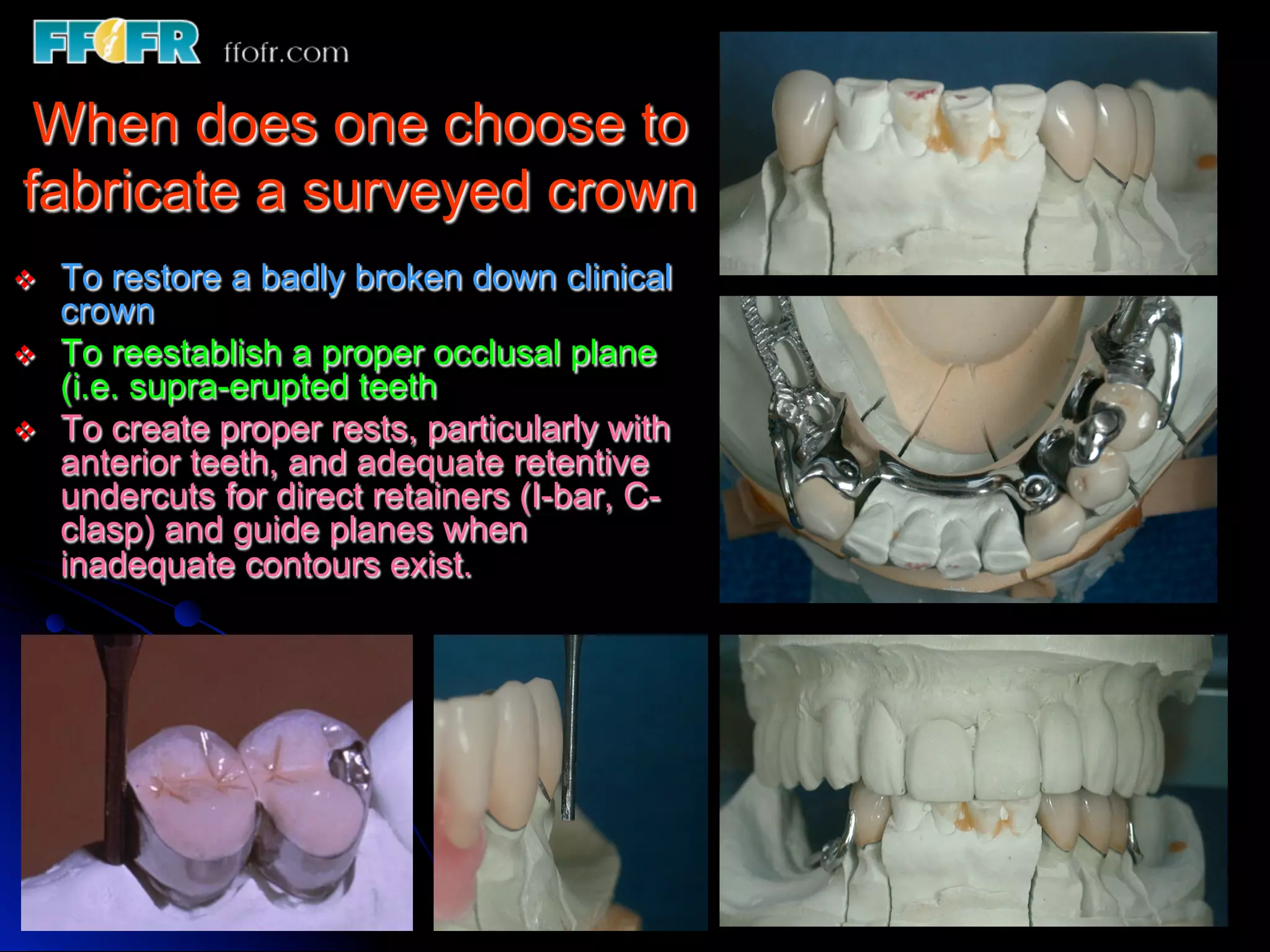 12.surveyed crowns and combined fixed rpd cases | PDF