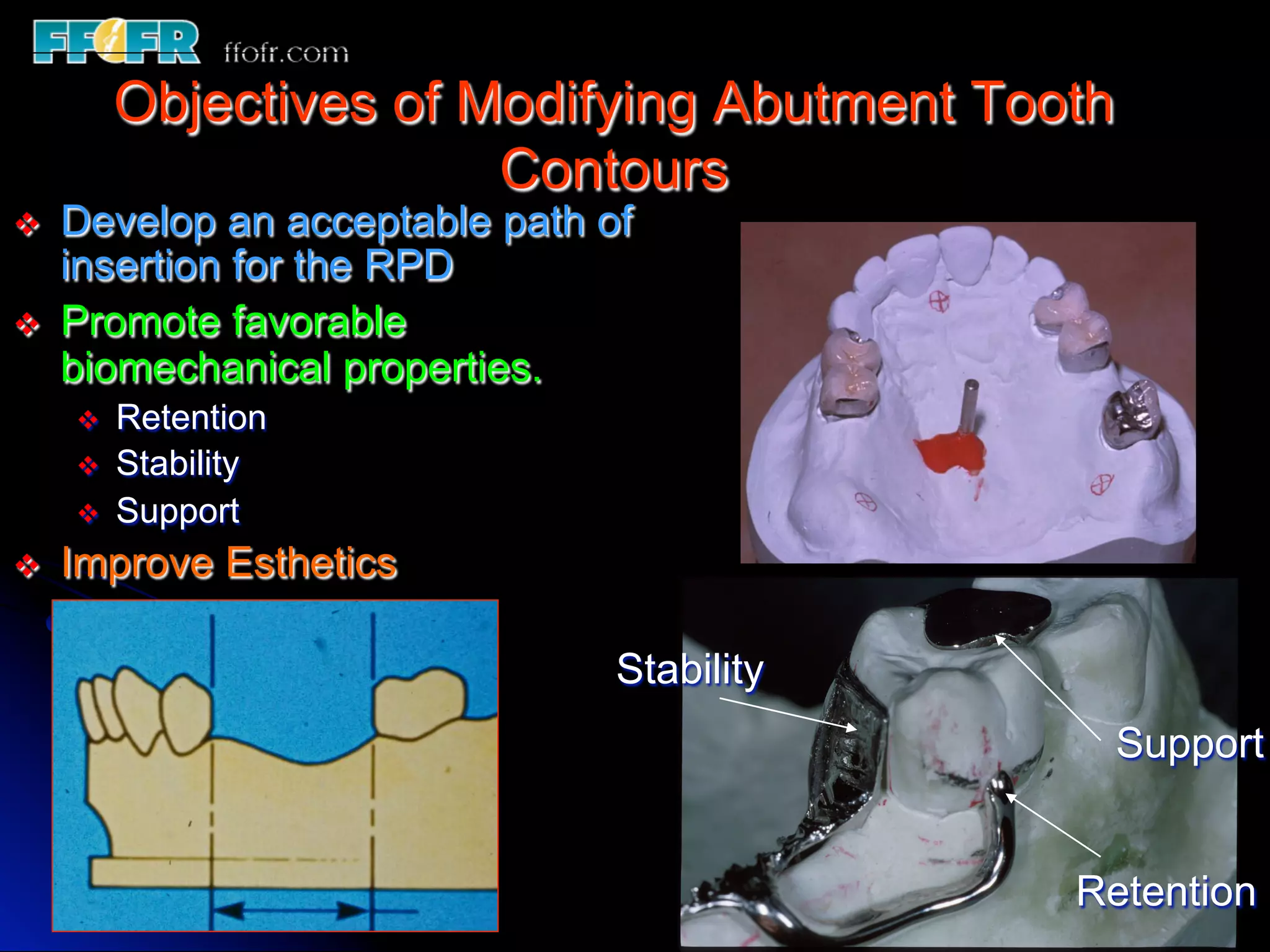 12.surveyed crowns and combined fixed rpd cases | PDF
