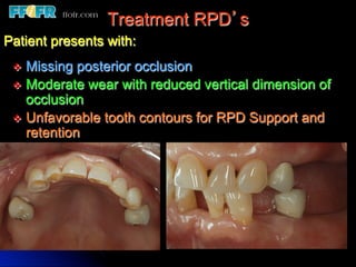 12.surveyed crowns and combined fixed rpd cases | PDF