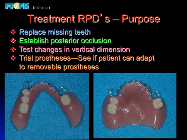 12.surveyed crowns and combined fixed rpd cases | PDF