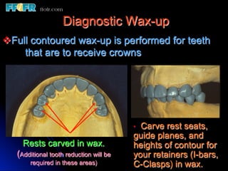 12.surveyed crowns and combined fixed rpd cases | PDF