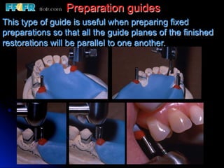 12.surveyed crowns and combined fixed rpd cases | PDF