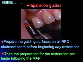 12.surveyed crowns and combined fixed rpd cases | PDF