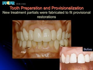 12.surveyed crowns and combined fixed rpd cases | PDF