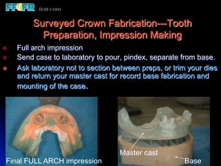12.surveyed crowns and combined fixed rpd cases | PDF